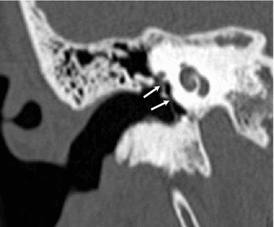 Chronic Otomastoiditis without Cholesteatoma | SpringerLink