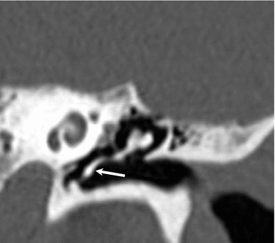 Chronic Otomastoiditis without Cholesteatoma | SpringerLink