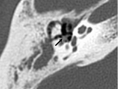 Chronic Otomastoiditis without Cholesteatoma | SpringerLink