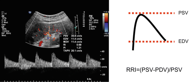 Renal Ultrasound (and Doppler Sonography) in Hypertension: An Update ...