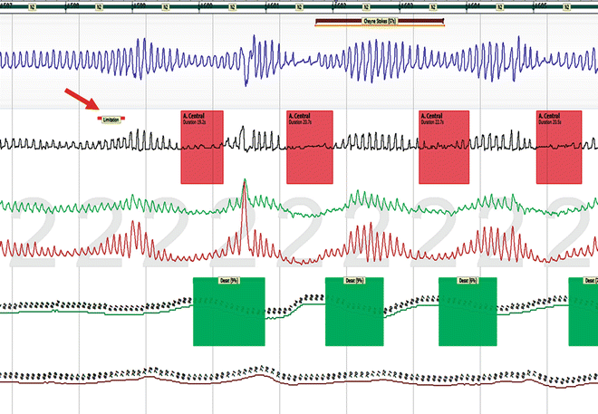 Central Sleep Apnea with Cheyne-Stokes Breathing in Heart Failure ...