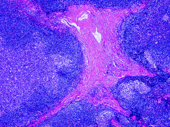 The Histopathology of IgG4-Related Disease | SpringerLink