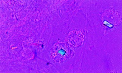 Calcium Pyrophosphate Dihydrate, Hydroxyapatite, and Miscellaneous ...