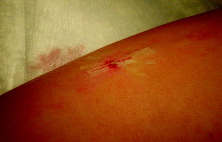 Implanon®: Insertion and Removal | SpringerLink