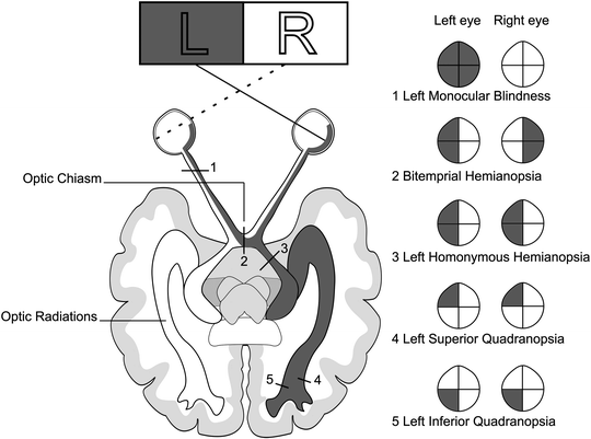Deficits in Visuospatial/Visuoconstructional Skills and Motor Praxis ...