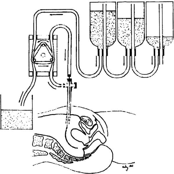 Peritoneal Dialysis Access and Exit-Site Care Including Surgical ...