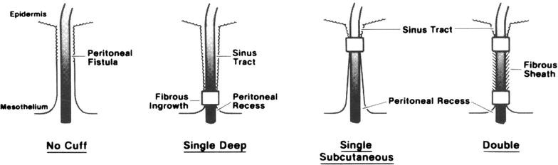 Peritoneal Dialysis Access and Exit-Site Care Including Surgical ...