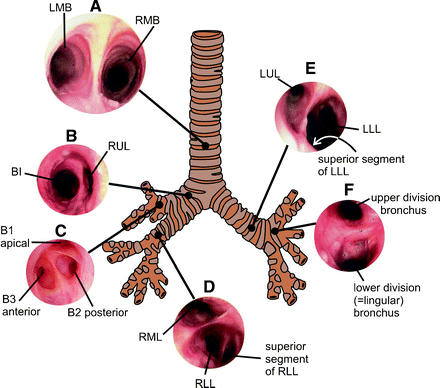 Bronchoscopic Anatomy | SpringerLink