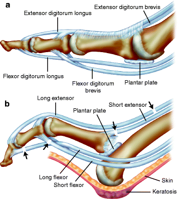 Surgical Treatment of Hammer Toe, Claw Toe, and Mallet Toe Deformity ...