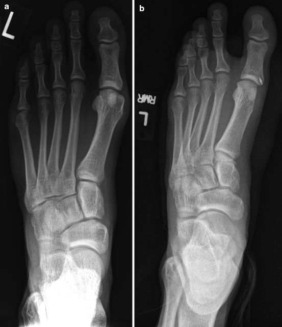 Turf Toe Injuries | SpringerLink