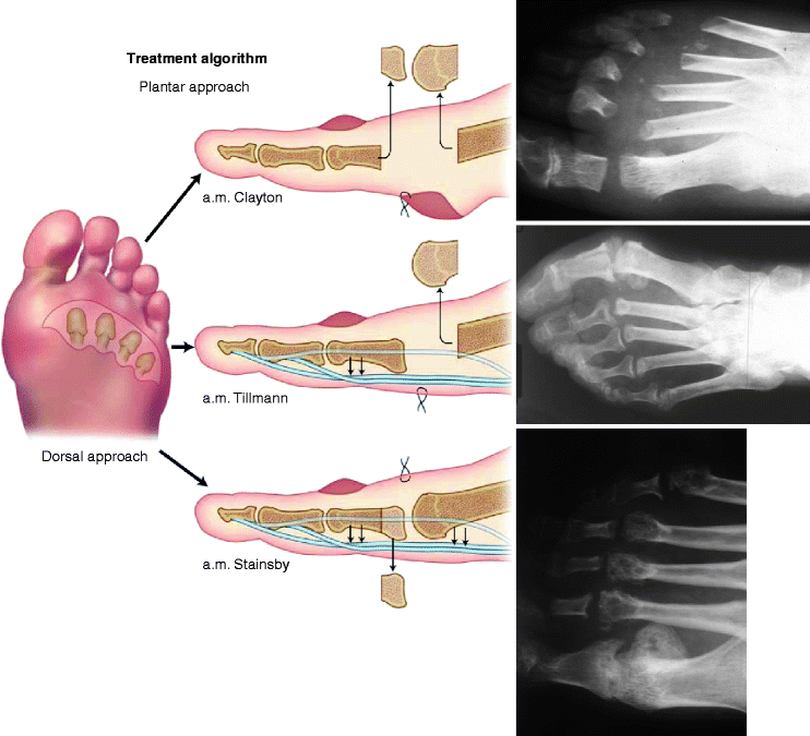 Rheumatoid Foot Reconstruction | SpringerLink