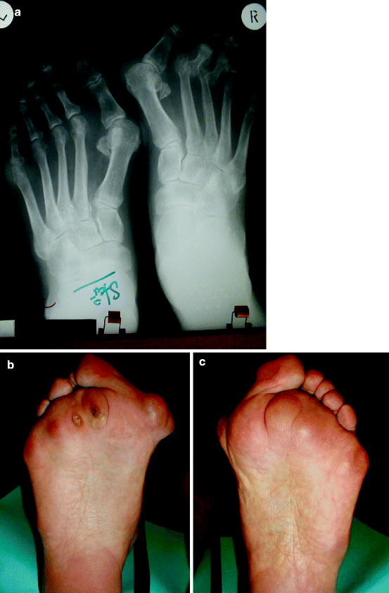 Rheumatoid Foot Reconstruction | SpringerLink