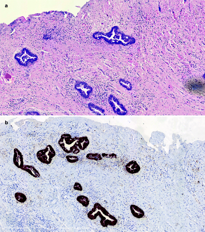 Cysts, Non neoplastic Glandular Lesions, and Glandular Neoplasms of the ...