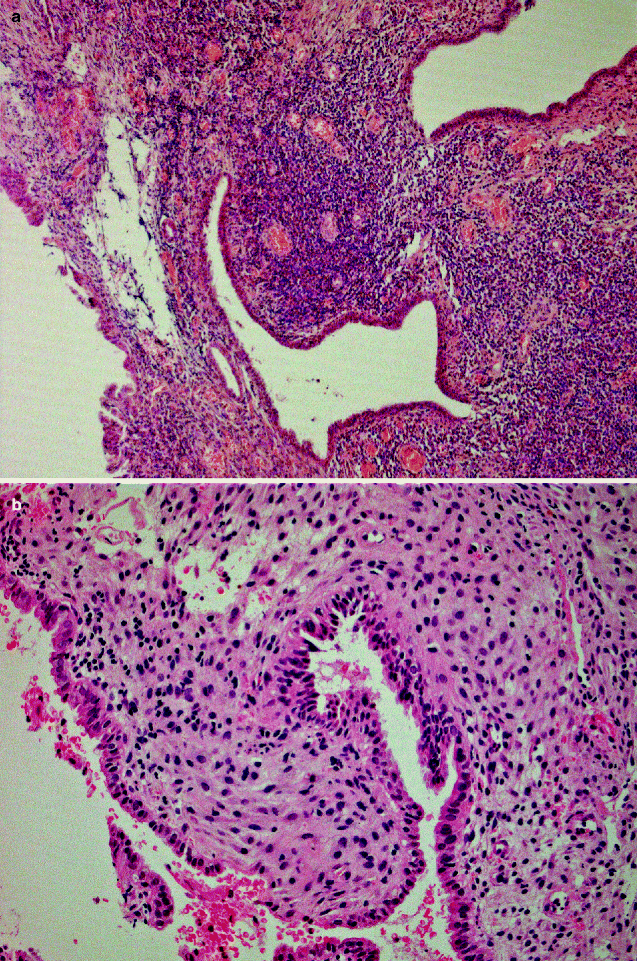 Cysts, Non neoplastic Glandular Lesions, and Glandular Neoplasms of the ...