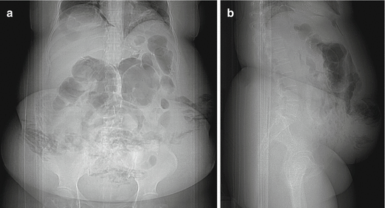 Post-operative Abdominal Wall Cellulitis | SpringerLink