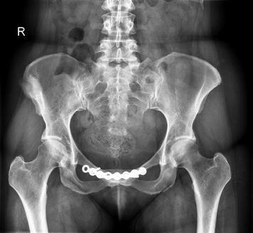 Pubic Symphysis Fusion | SpringerLink