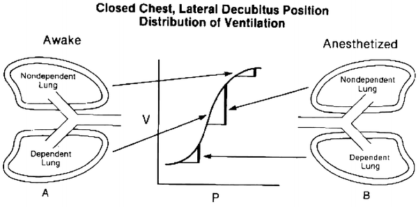 Physiology of the Lateral Decubitus Position, Open Chest and One-Lung ...