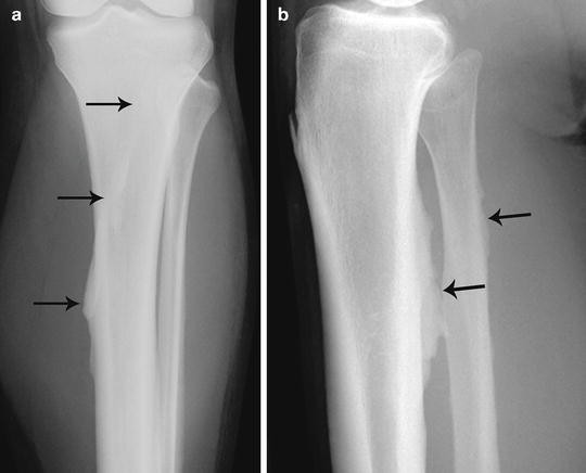 Bone Tumor Mimickers | SpringerLink