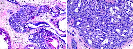 Risk Lesions of the Breast: Usual Ductal Hyperplasia, Atypical Ductal ...