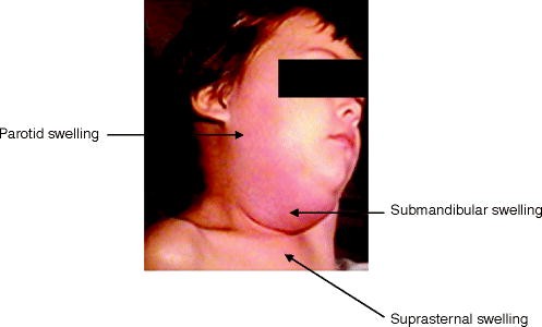Mumps is Back: Why is Mumps Eradication Not Working? | SpringerLink