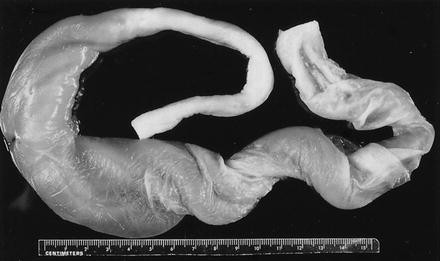 Pathology of the Umbilical Cord | SpringerLink