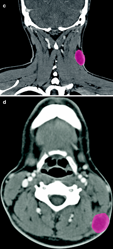 Head and Neck Lymph Node Anatomy | SpringerLink