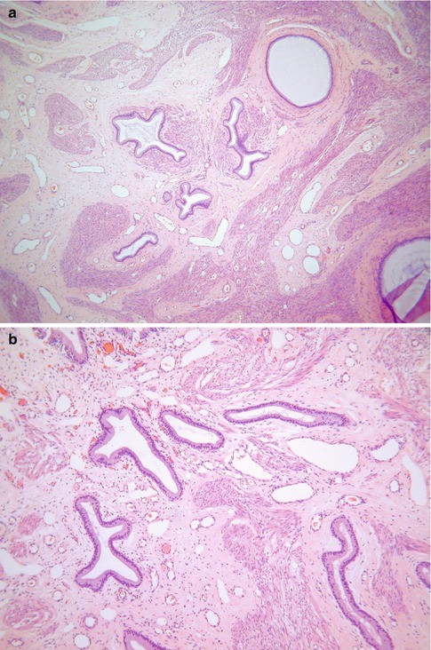 Benign Endocervical Glandular Lesions | SpringerLink