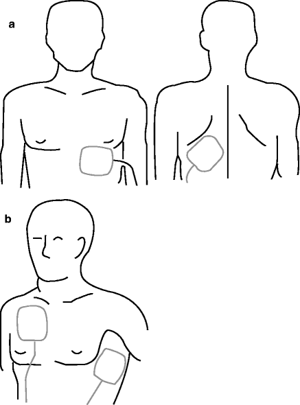Temporary Cardiac Pacing | SpringerLink