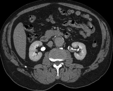 How to Do a CT Urogram (CTU) | SpringerLink