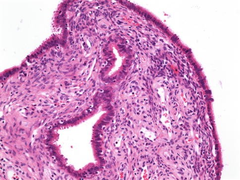 Pathology of the Fallopian Tube | SpringerLink