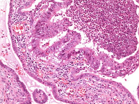 Pathology of the Fallopian Tube | SpringerLink