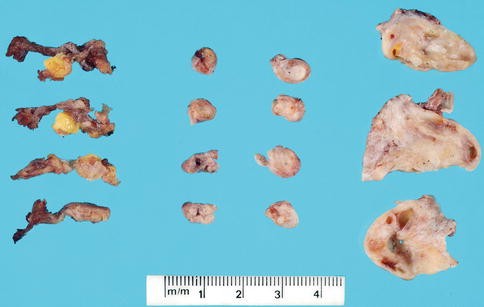 Pathology of the Fallopian Tube | SpringerLink