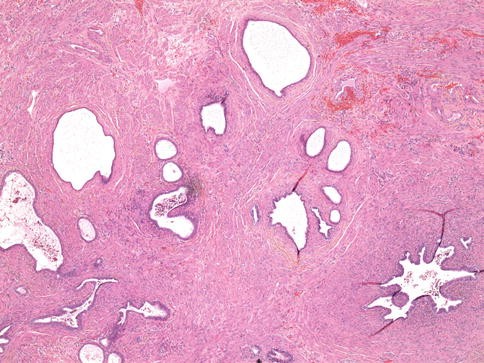 Pathology of the Fallopian Tube | SpringerLink