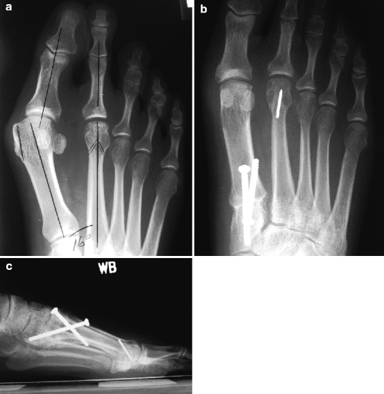 The Lapidus Procedure | SpringerLink