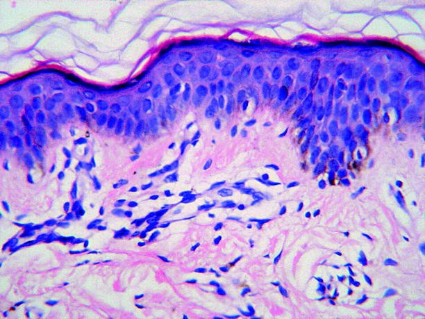 A Child with Hypopigmented Skin, Grey Hair, Neurological and ...