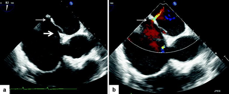 Transseptal Puncture | SpringerLink