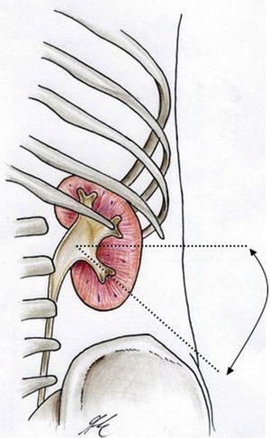 Tips to Puncture the Kidney Using Ultrasound | SpringerLink