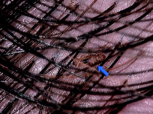 Parasitic Scalp Infections | SpringerLink