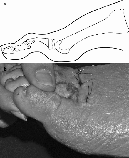 Minimally Invasive Management of Dorsiflexion Contracture at the ...