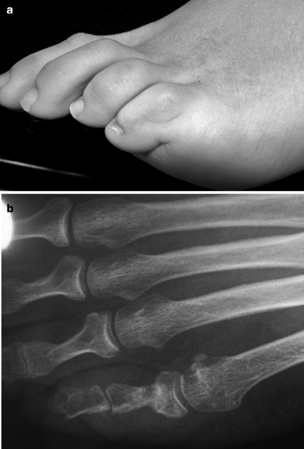 Minimally Invasive Management of Dorsiflexion Contracture at the ...
