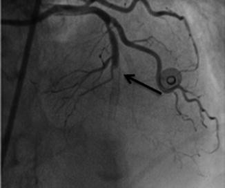 Pathophysiology of Coronary Artery Disease | SpringerLink