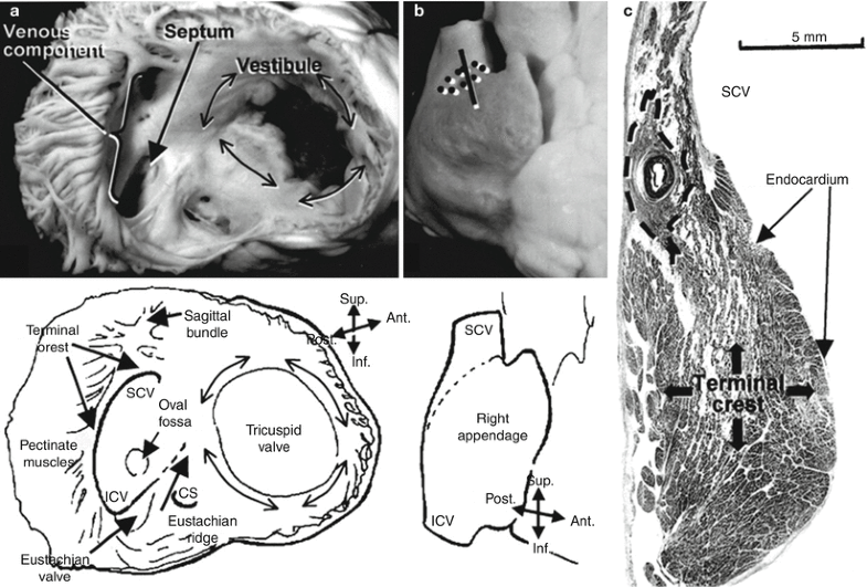 Importance of Isthmus Structure in the Right Atrium | SpringerLink