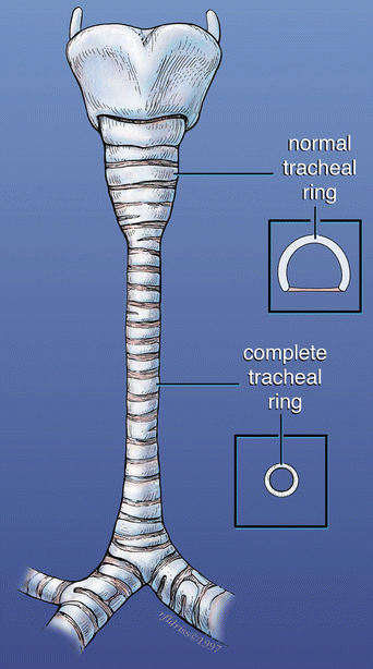 Vascular Rings, Tracheoplasty, and Pulmonary Artery Sling | SpringerLink