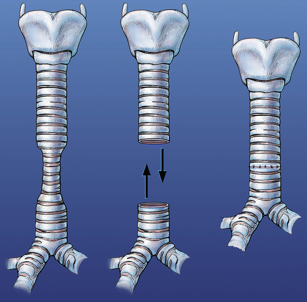 Vascular Rings, Tracheoplasty, and Pulmonary Artery Sling | SpringerLink