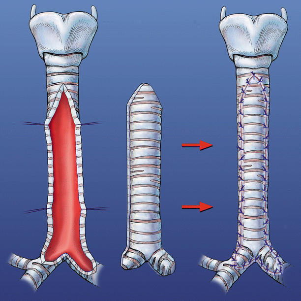 Vascular Rings, Tracheoplasty, and Pulmonary Artery Sling | SpringerLink