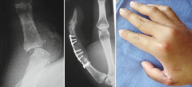 Acute Thumb and Finger Instability | SpringerLink