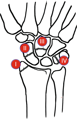 Greater Arc Injuries: Perilunate Fracture-Dislocations | SpringerLink