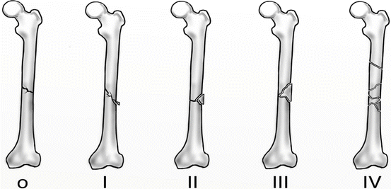 Femoral Shaft Fractures | SpringerLink