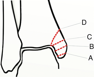 Medial Malleoli Fractures | SpringerLink