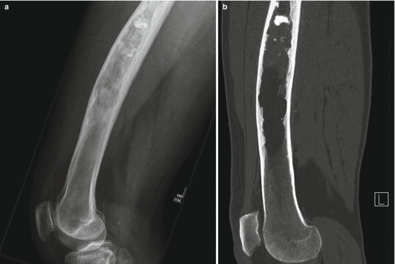 An Imaging Approach to Bone Tumors | SpringerLink
